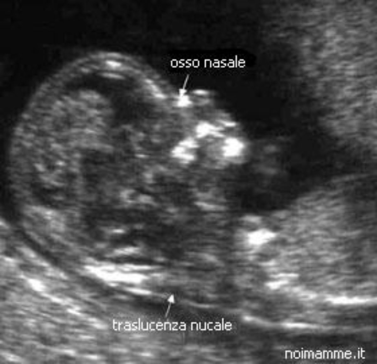 Translucenza Nucale, Bitest E Tritest: Guida Completa Allo Screening ...